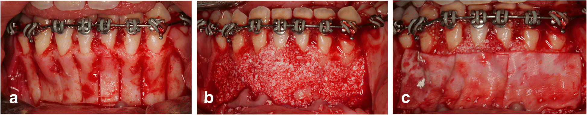 Changes of alveolar bone dehiscence and fenestration after augmented ...