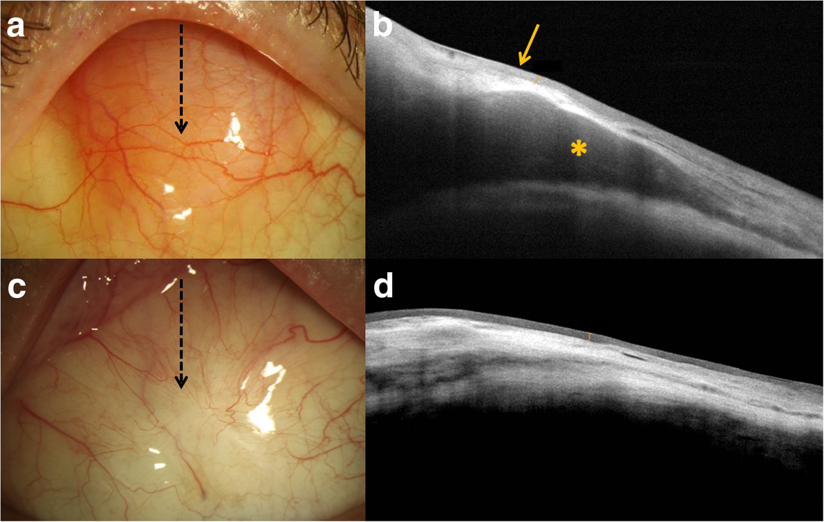 Classification, diagnosis, and management of conjunctival lymphoma ...