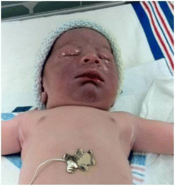 Nuchal cord and its implications | SpringerLink