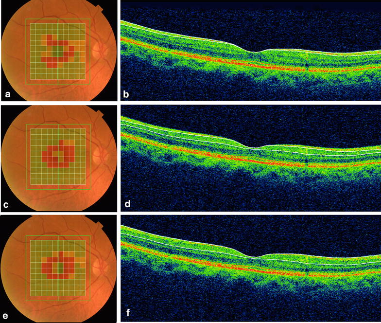 The role of optical coherence tomography in Alzheimer’s disease ...