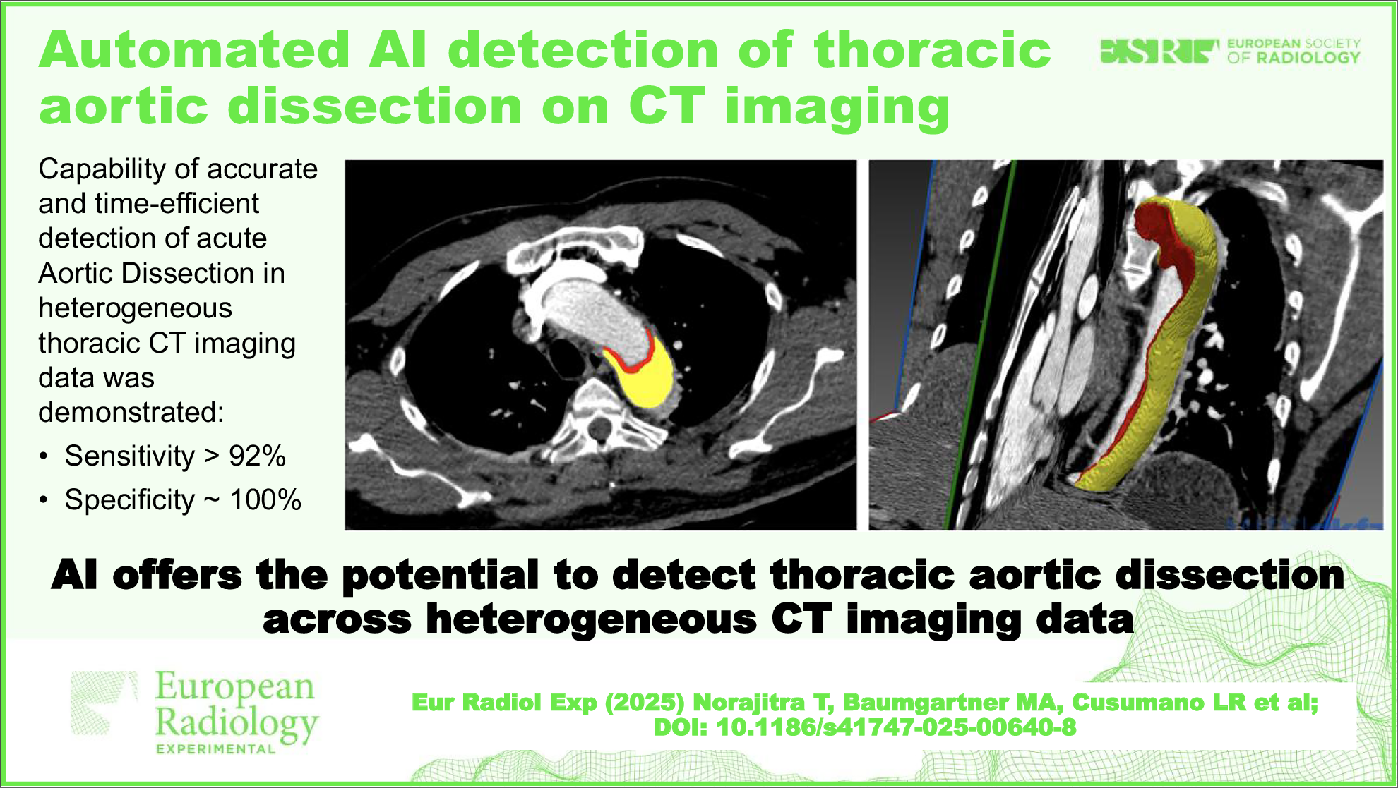 Aortic Dissection | Automated AI detection of thoracic aortic ...