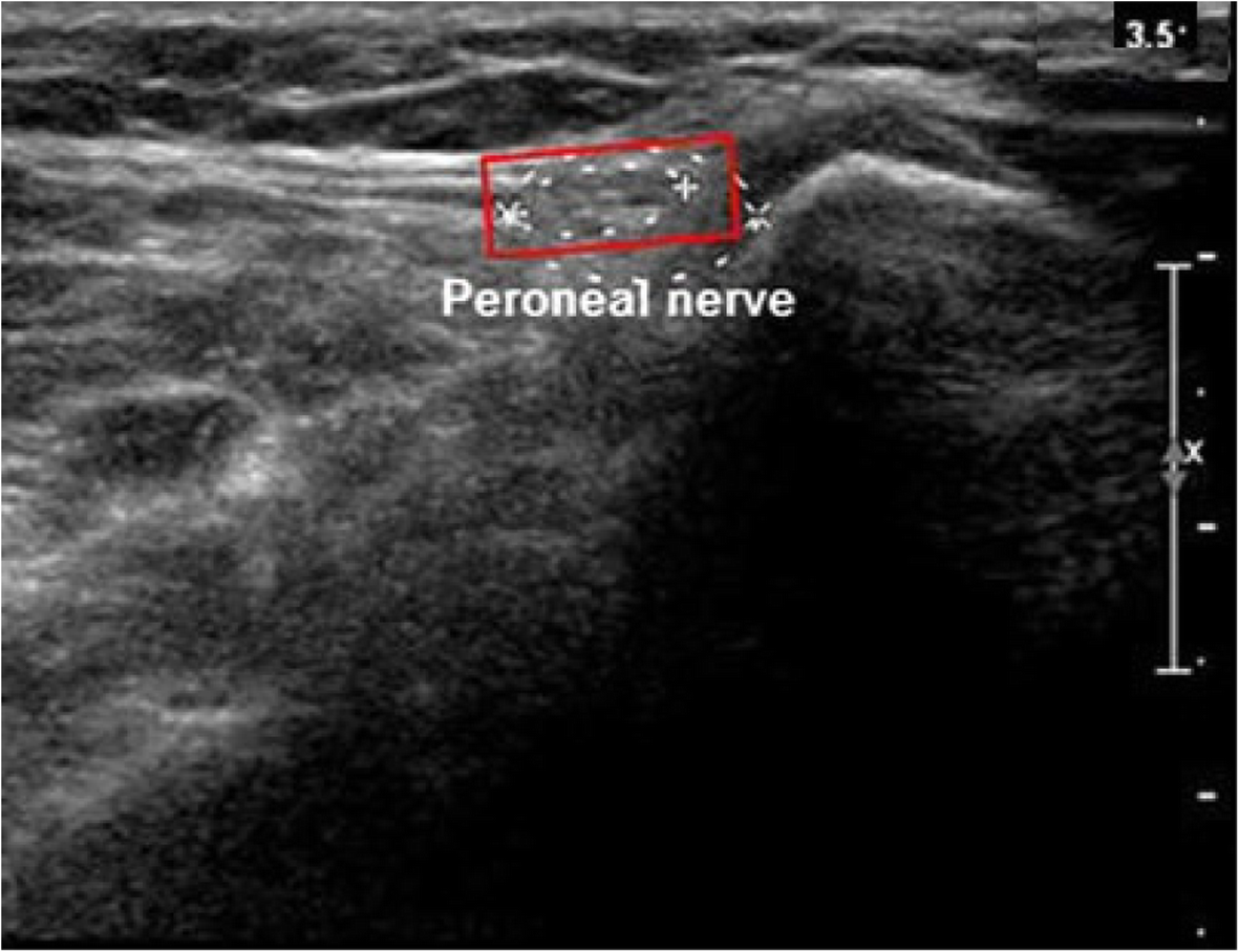 Role of superficial peroneal sensory potential and high-resolution ...