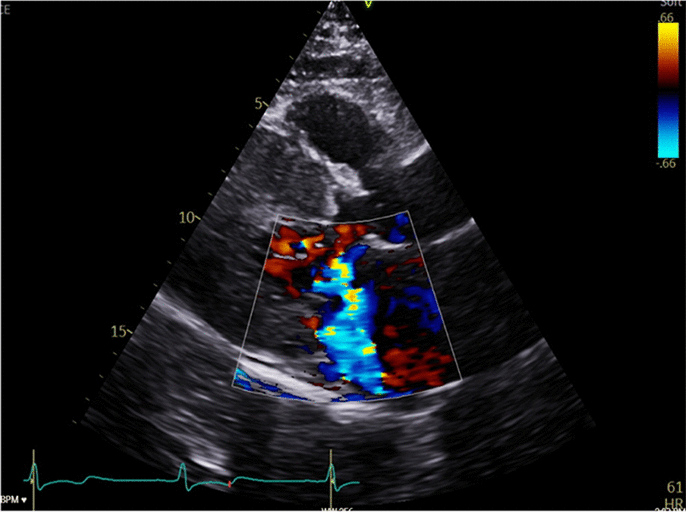 British Society of Echocardiography guideline for the transthoracic ...