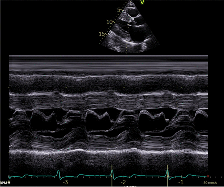 British Society of Echocardiography guideline for the transthoracic ...