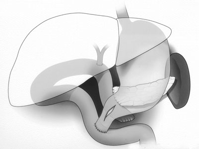 Is Pylorospasm a Cause of Delayed Gastric Emptying After Pylorus ...