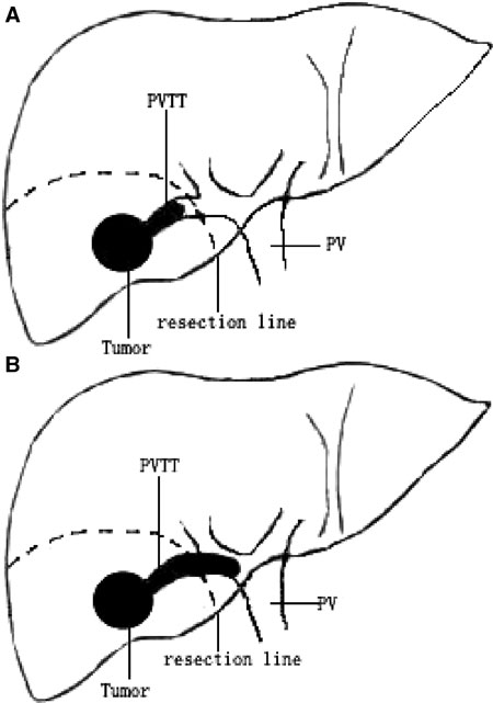 Effects of Location and Extension of Portal Vein Tumor Thrombus on Long ...