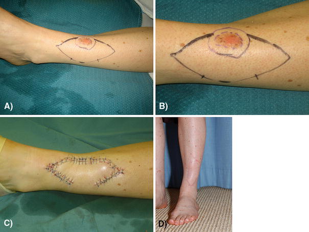 Keystone Flap Reconstruction of Primary Melanoma Excision Defects of ...