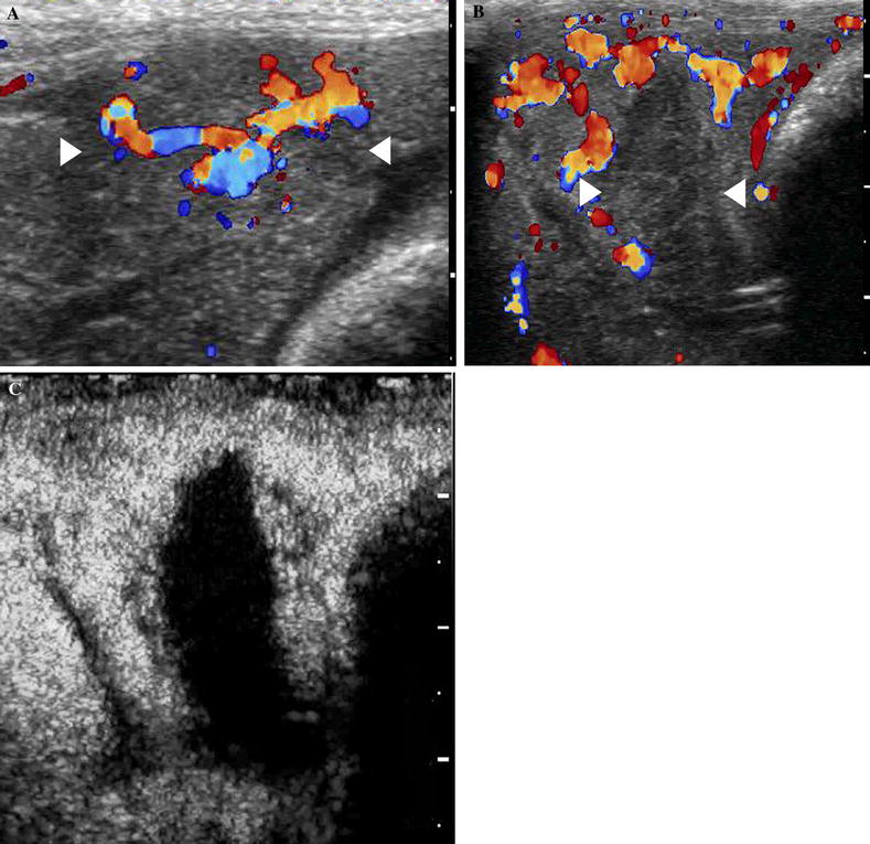 Ablation of High Intensity Focused Ultrasound Combined with SonoVue on ...