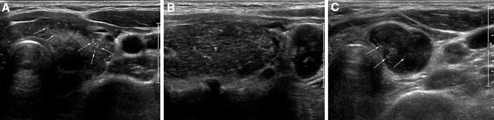 Diffuse Microcalcifications Only of the Thyroid Gland Seen on ...
