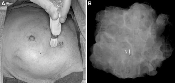 Radioactive Seed Localization for Nonpalpable Breast Lesions: Review of ...
