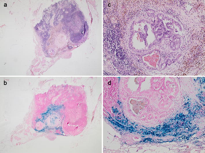 A Novel Method for Intraoperative Sentinel Lymph Node Detection in ...