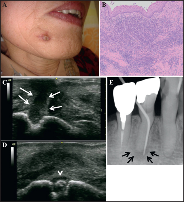 Usefulness of ultrasonography for rapidly diagnosing cutaneous sinus ...