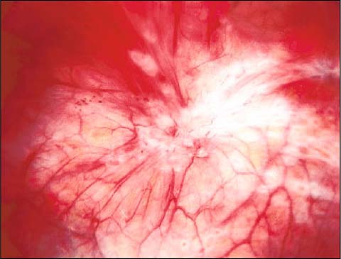 Endometriosis | SpringerLink