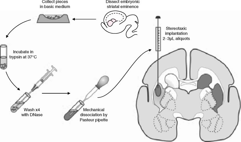 Neural Transplantation in Patients with Huntington’s Disease | SpringerLink