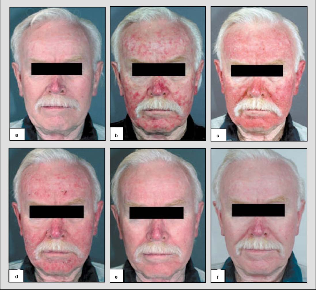 New Approaches to the Treatment of Actinic Keratosis | SpringerLink
