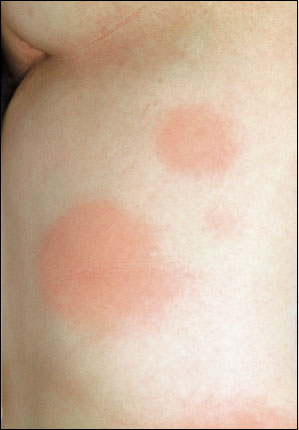 Fixed Drug Eruptions | SpringerLink