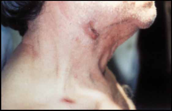 Cutaneous Tuberculosis | SpringerLink