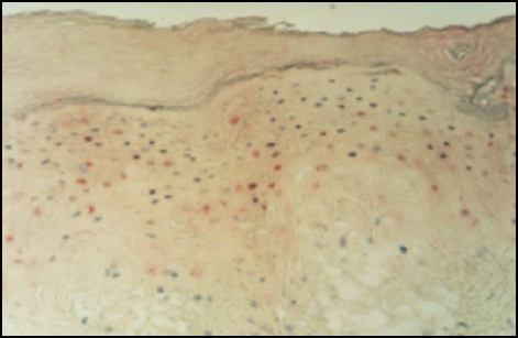 Treatment of Mucocutaneous Presentations of Herpes Simplex Virus ...