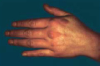 Dermatologic Signs in Patients with Eating Disorders | SpringerLink