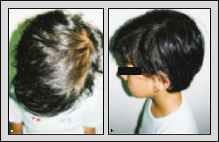 Monilethrix | SpringerLink