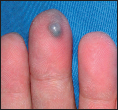 Metastasis of Mediastinal Epithelioid Angiosarcoma to the Finger ...