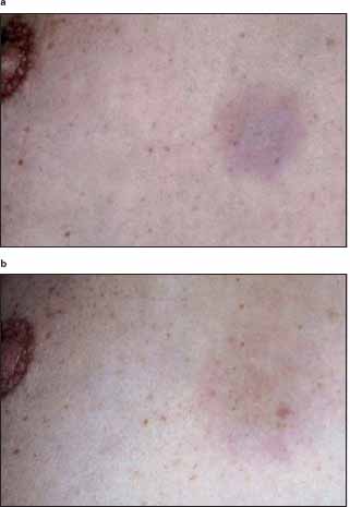 Efficacy of Topical Tacrolimus 0.1% in Active Plaque Morphea | SpringerLink