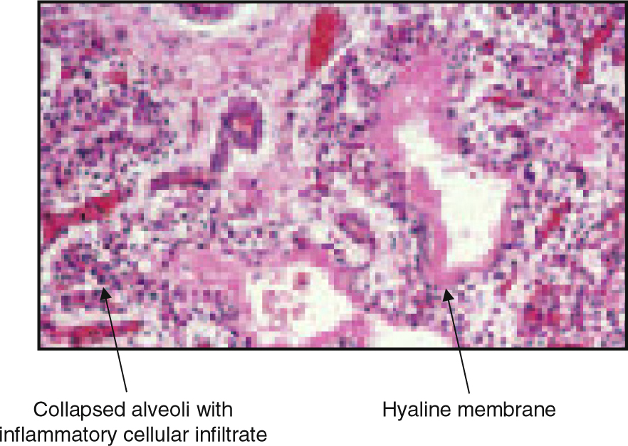 Pathophysiology of Neonatal Respiratory Distress Syndrome | SpringerLink