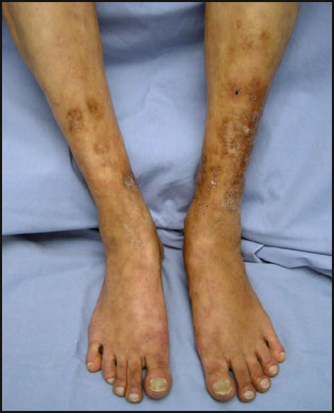 Healing of Ulcers due to Cryofibrinogenemia with Colchicine and High ...