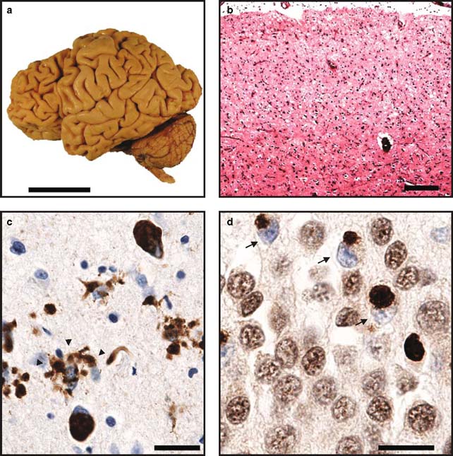 Frontotemporal lobar degeneration | SpringerLink