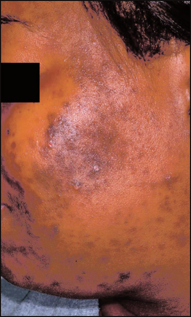 Postinflammatory Hyperpigmentation | SpringerLink