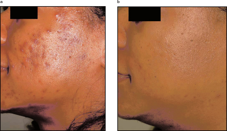 Postinflammatory Hyperpigmentation | SpringerLink