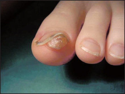 Nail Disorders in Children | SpringerLink