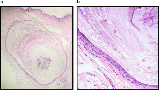 Eruptive Vellus Hair Cysts | SpringerLink