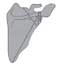 De floating shoulder | SpringerLink