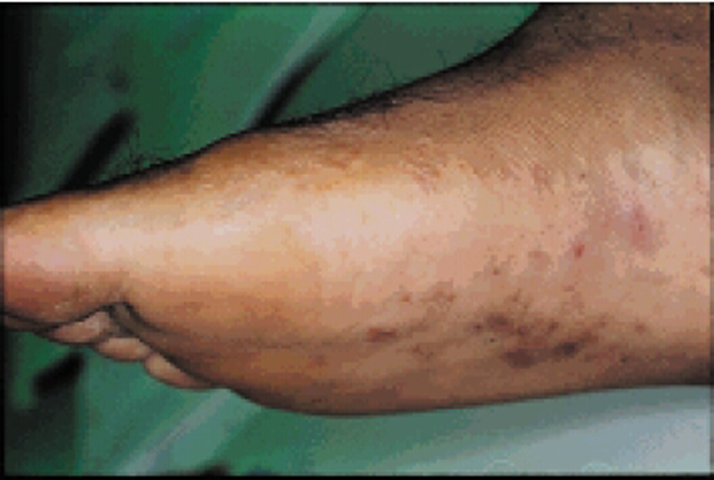 Eczeem | SpringerLink