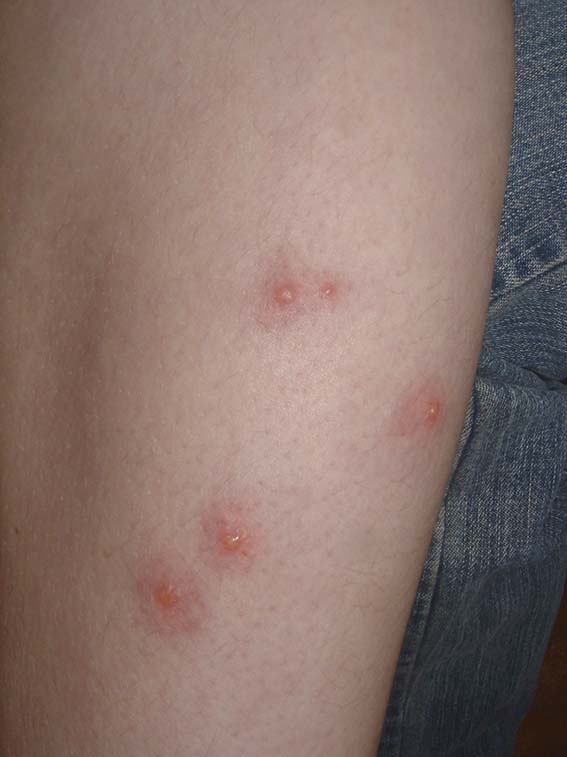 Blaasjes met en zonder koorts: waterpokken, gordelroos, koortslip ...