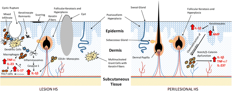 The critical role of macrophages in the pathogenesis of hidradenitis ...