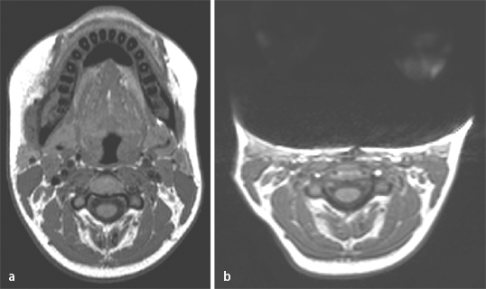 Predictability of magnetic susceptibility artifacts from metallic ...