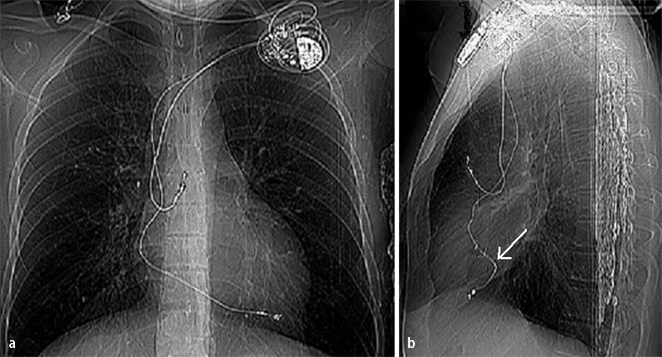 Inadvertent placement of pacemaker lead into the middle cardiac vein ...