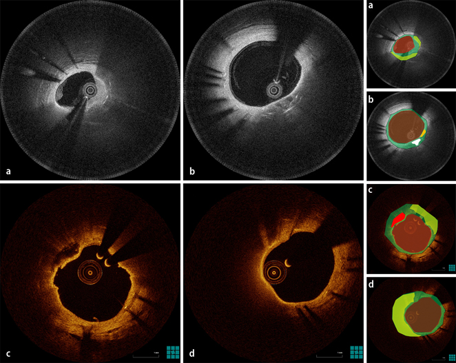 OCT demonstrating neoatherosclerosis as part of the continuous process ...