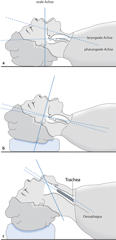 Vermeidbare Fehler bei der Intubation | SpringerLink