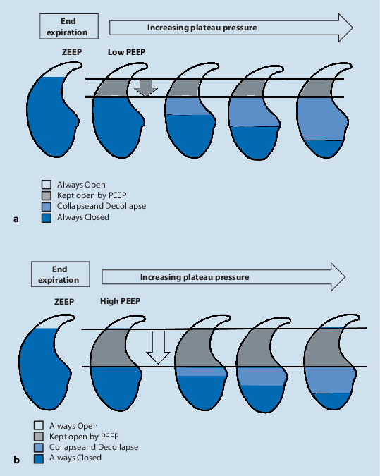Does high PEEP prevent alveolar cycling? | SpringerLink