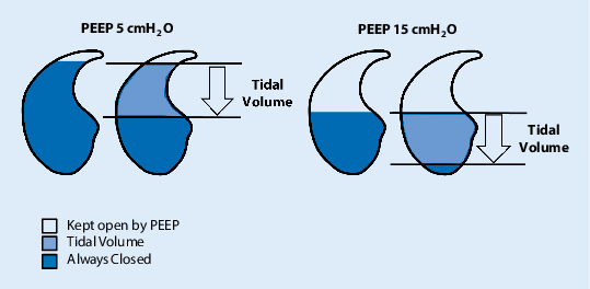 Does high PEEP prevent alveolar cycling? | SpringerLink