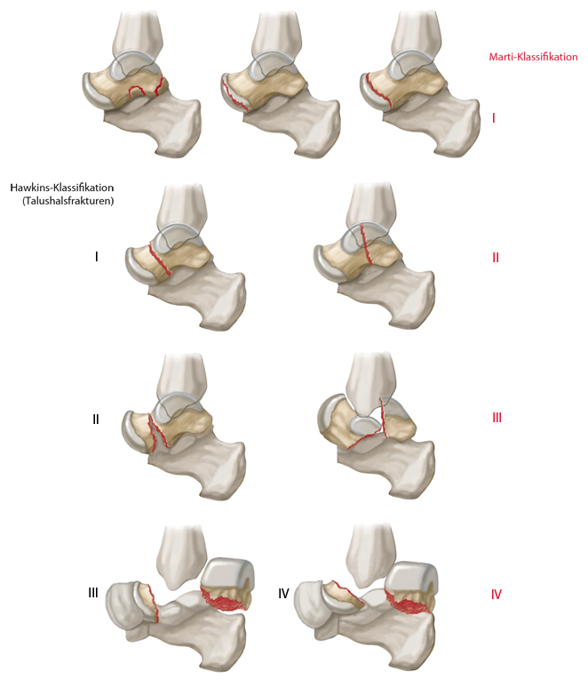 Osteosynthese zentraler Talusfrakturen | SpringerLink