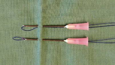 Die arthroskopisch unterstützte transkapsuläre Refixation des Discus ...