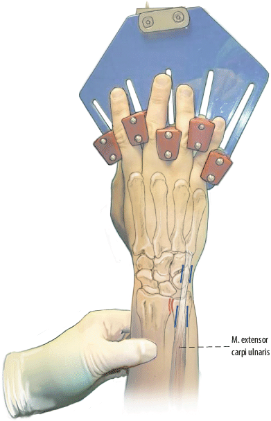 Die arthroskopisch unterstützte transkapsuläre Refixation des Discus ...