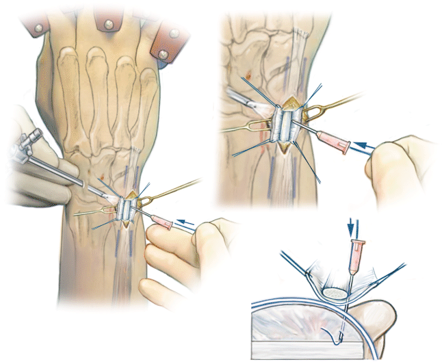 Die arthroskopisch unterstützte transkapsuläre Refixation des Discus ...