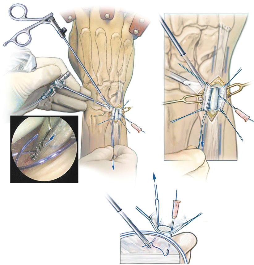 Die arthroskopisch unterstützte transkapsuläre Refixation des Discus ...