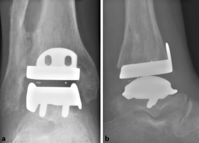 Aseptische Lockerung einer OSG‑Endoprothese | SpringerLink