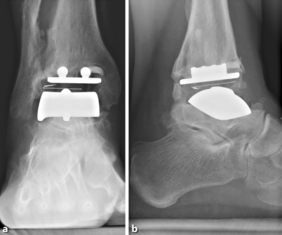 Aseptische Lockerung einer OSG‑Endoprothese | SpringerLink
